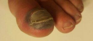 Dropped Something Heavy on Your Big Toe? Is it Fractured, Sprained or ...