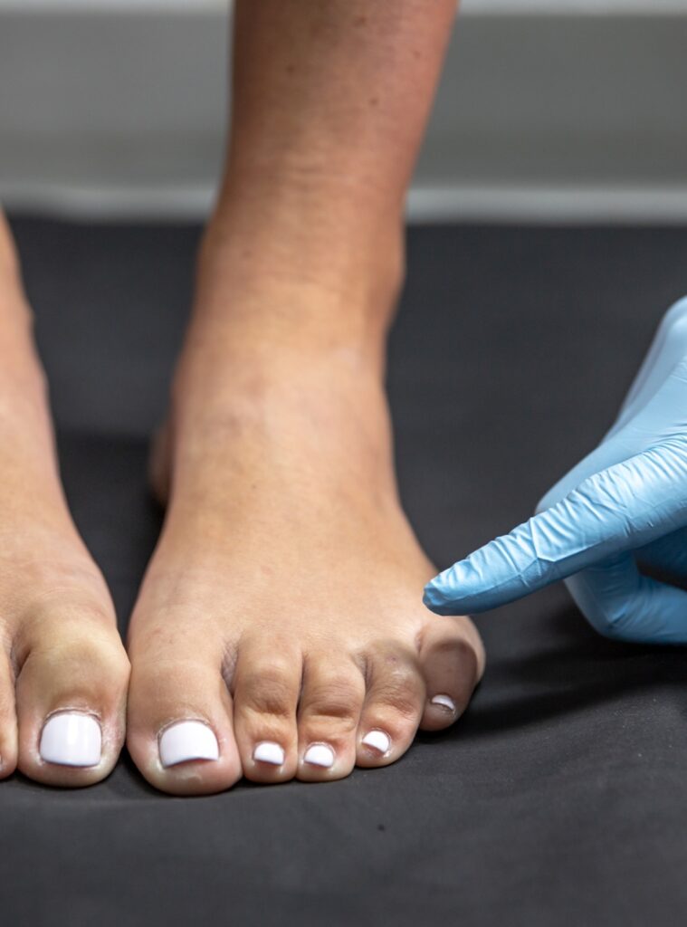 Broken Toes – Belmont Anderson DPM Las Vegas Podiatrist